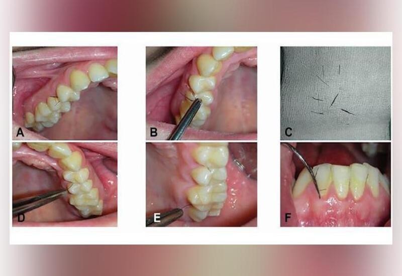 25-yr-old Italian woman with rare condition has hair growing out of her ...