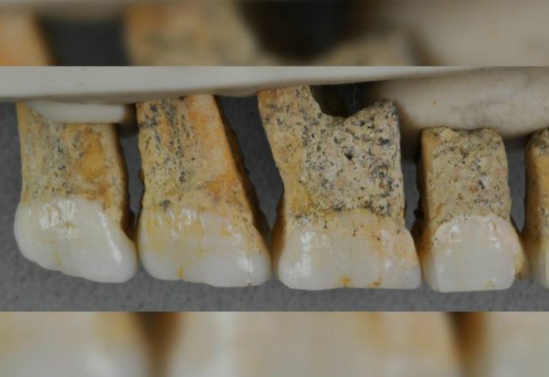 Tooth Found Growing inside Chinese Man's Nostrils for Years after He ...